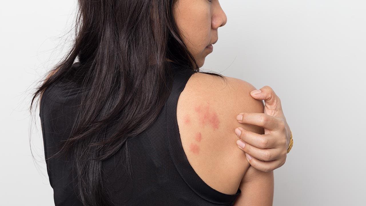Got Hives? What You’re Itching to Know about Chronic Urticaria | Tyler ...
